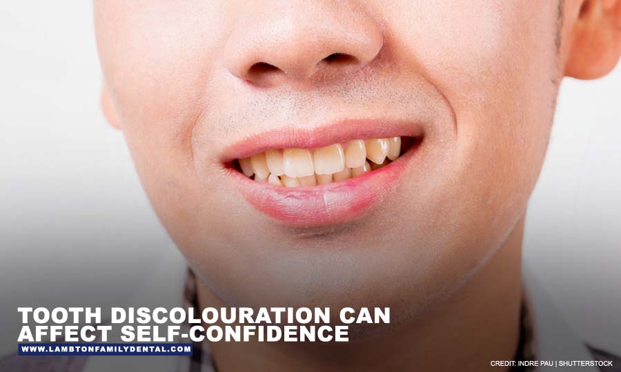 Are DIY Teeth Whitening Safe and Effective? | Lambton Family Dental