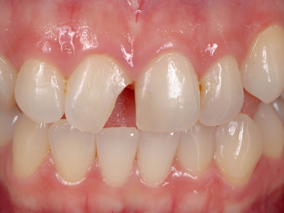 How to Prevent Dental Emergencies While Playing Sports | Lambton Family ...